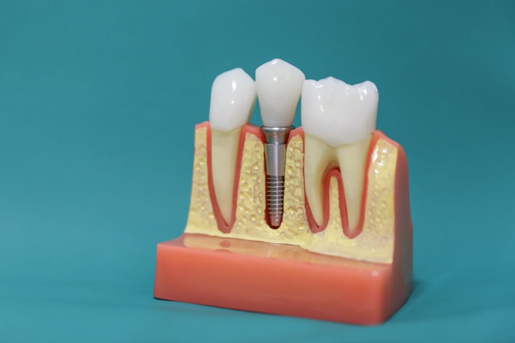 Dental Implant Healing Caps: What Every Patient Needs to Know